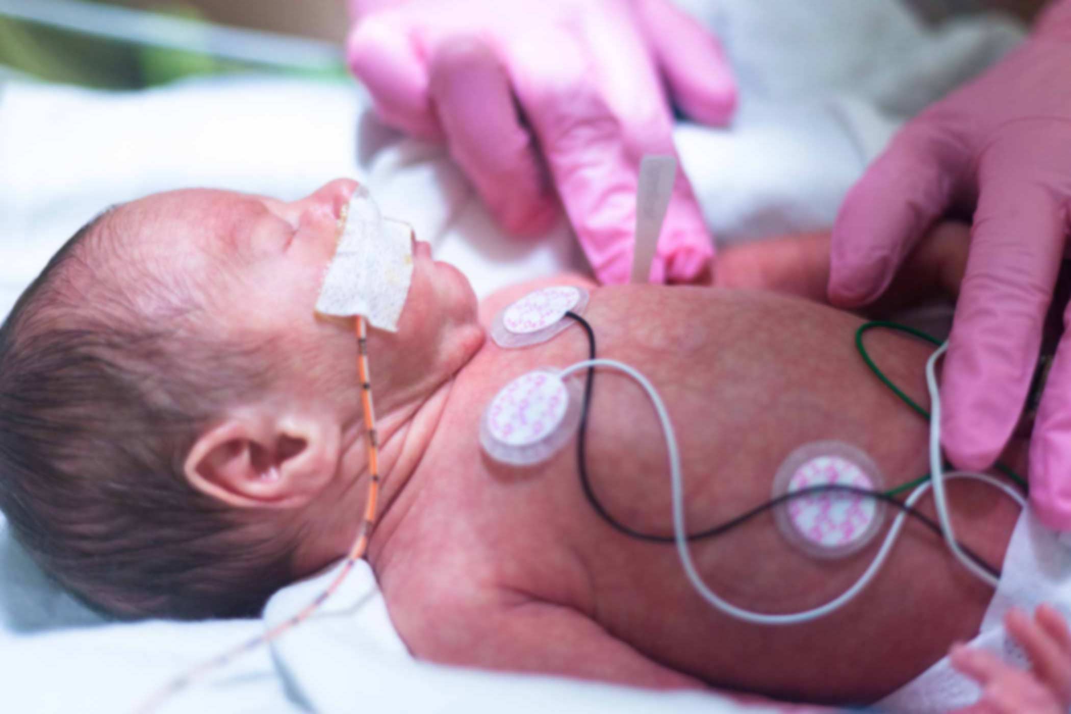 Neonatal Resuscitation - RN.com