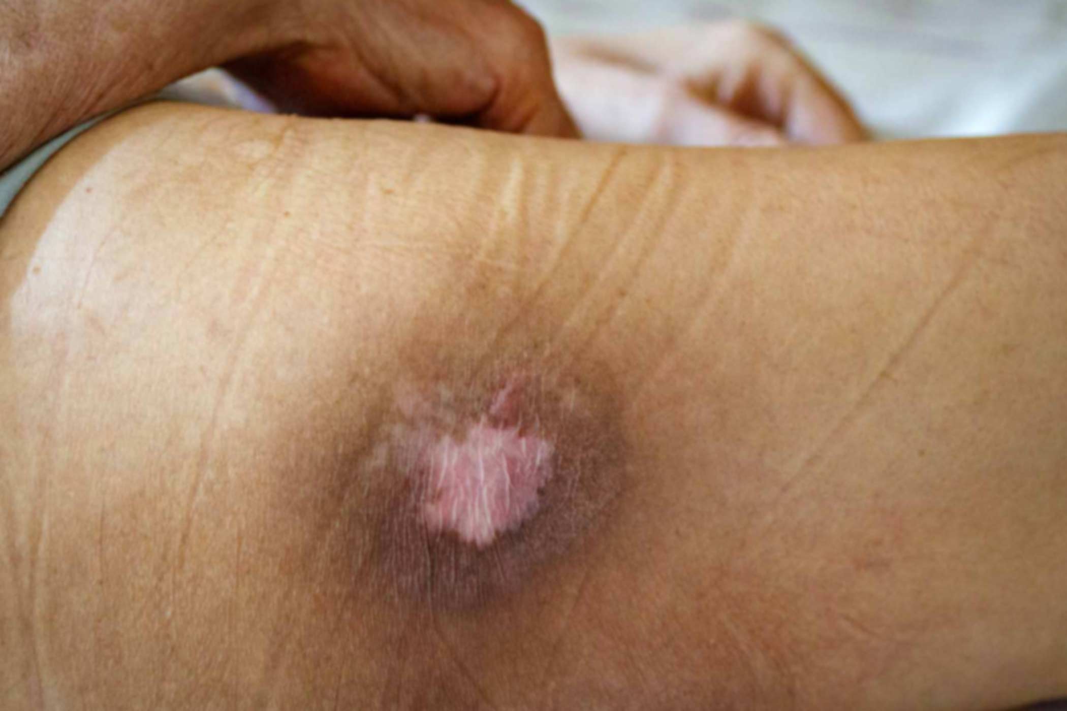 Assessment, Prevention, and Management of Hospital Acquired Pressure ...